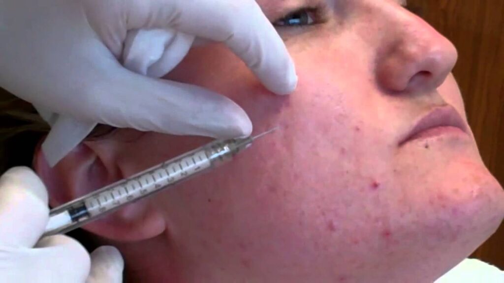 Bellafill Treatment: Understanding Its Effectiveness and Cost - Body ...